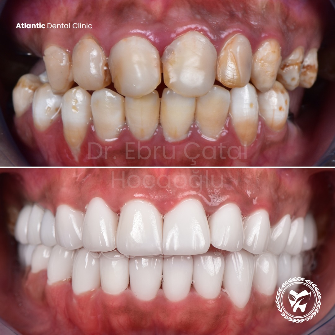 Bite Correction – ATLANTIC DENTAL CLINIC