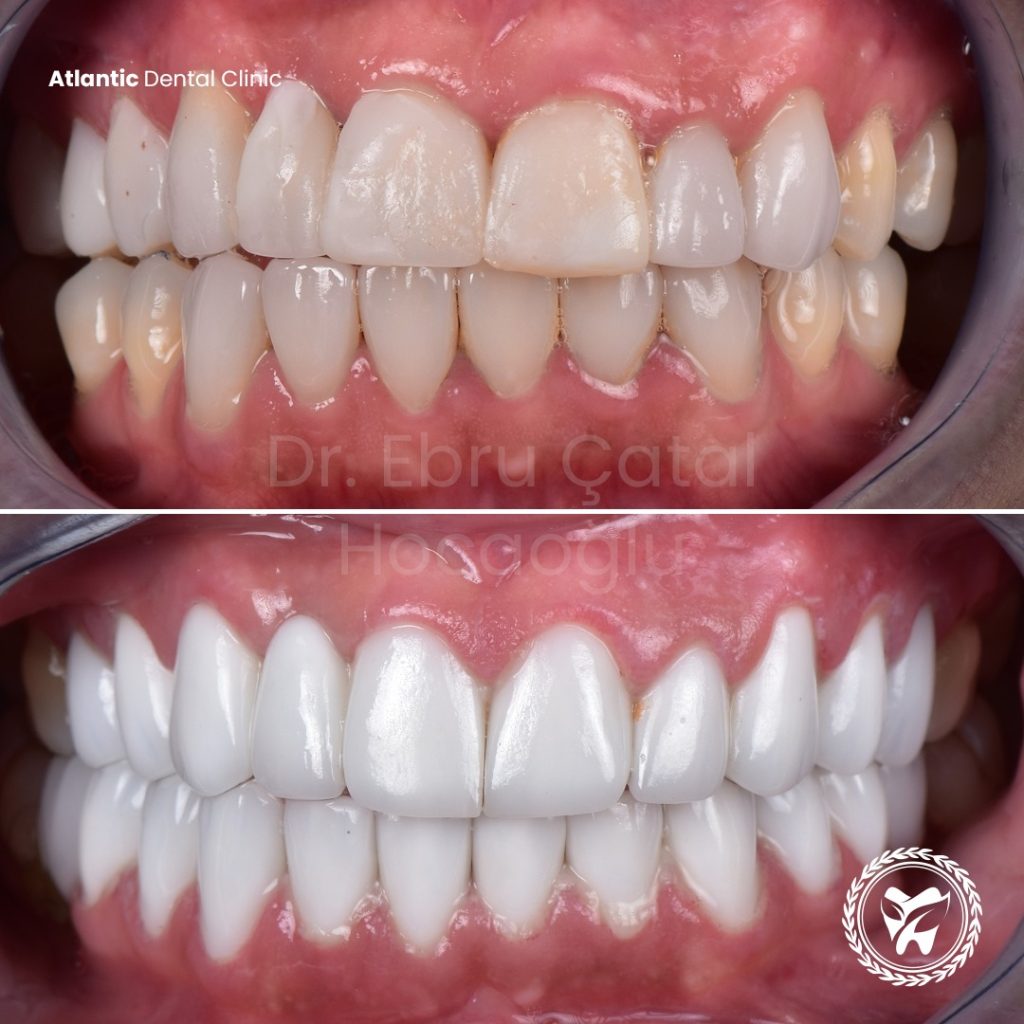 Midline Correction – ATLANTIC DENTAL CLINIC