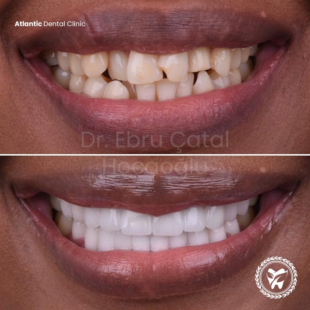 Midline Correction – ATLANTIC DENTAL CLINIC